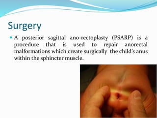 Anorectal malformation .pptx
