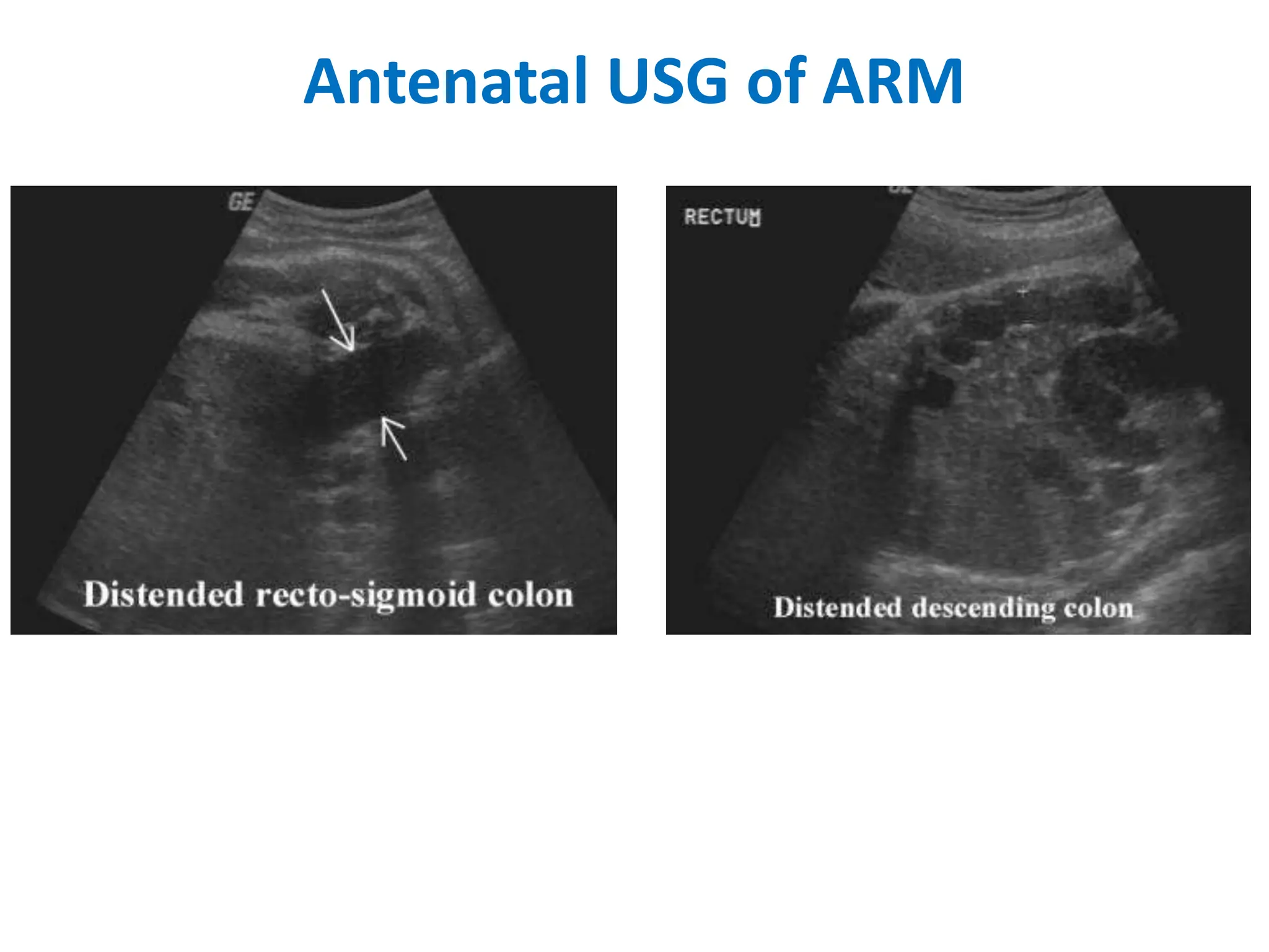 Anorectal malformation.pptx