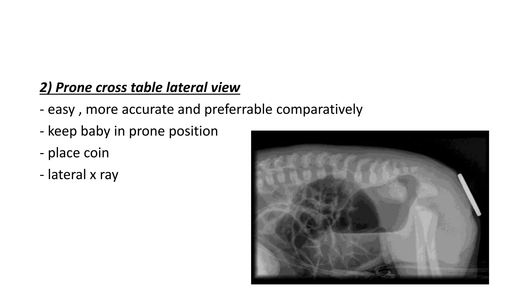 Anorectal Malformation.pptx