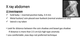 Anorectal Malformation.pptx