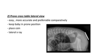 Anorectal Malformation.pptx