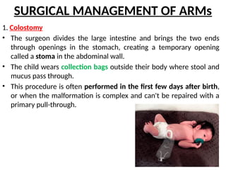 anorectal malformation. pptx | PPTX