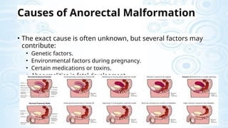 Anorectal Malformation. Surgery Presentation | PPTX