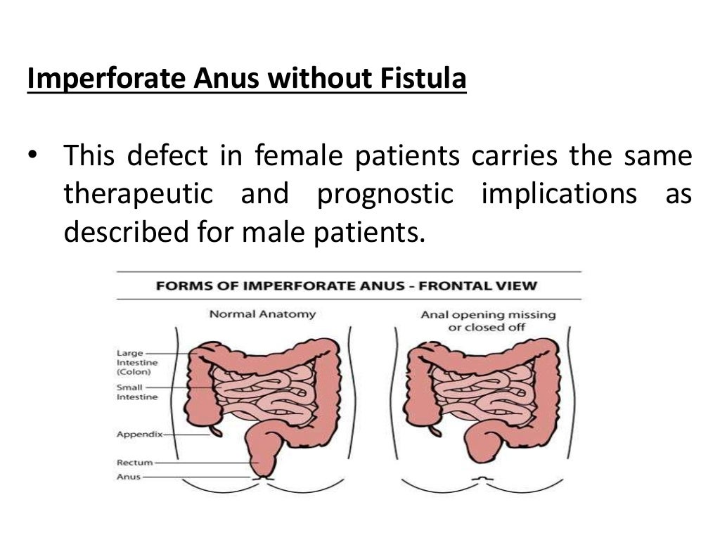 Anorectal malformation seminar
