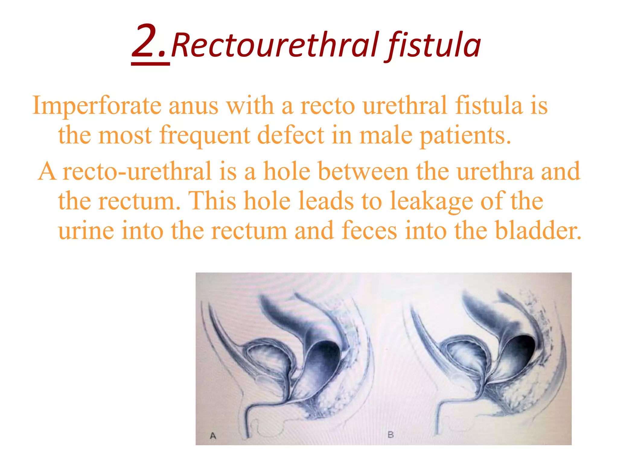 Anorectal malformation ppt 5 | PPT