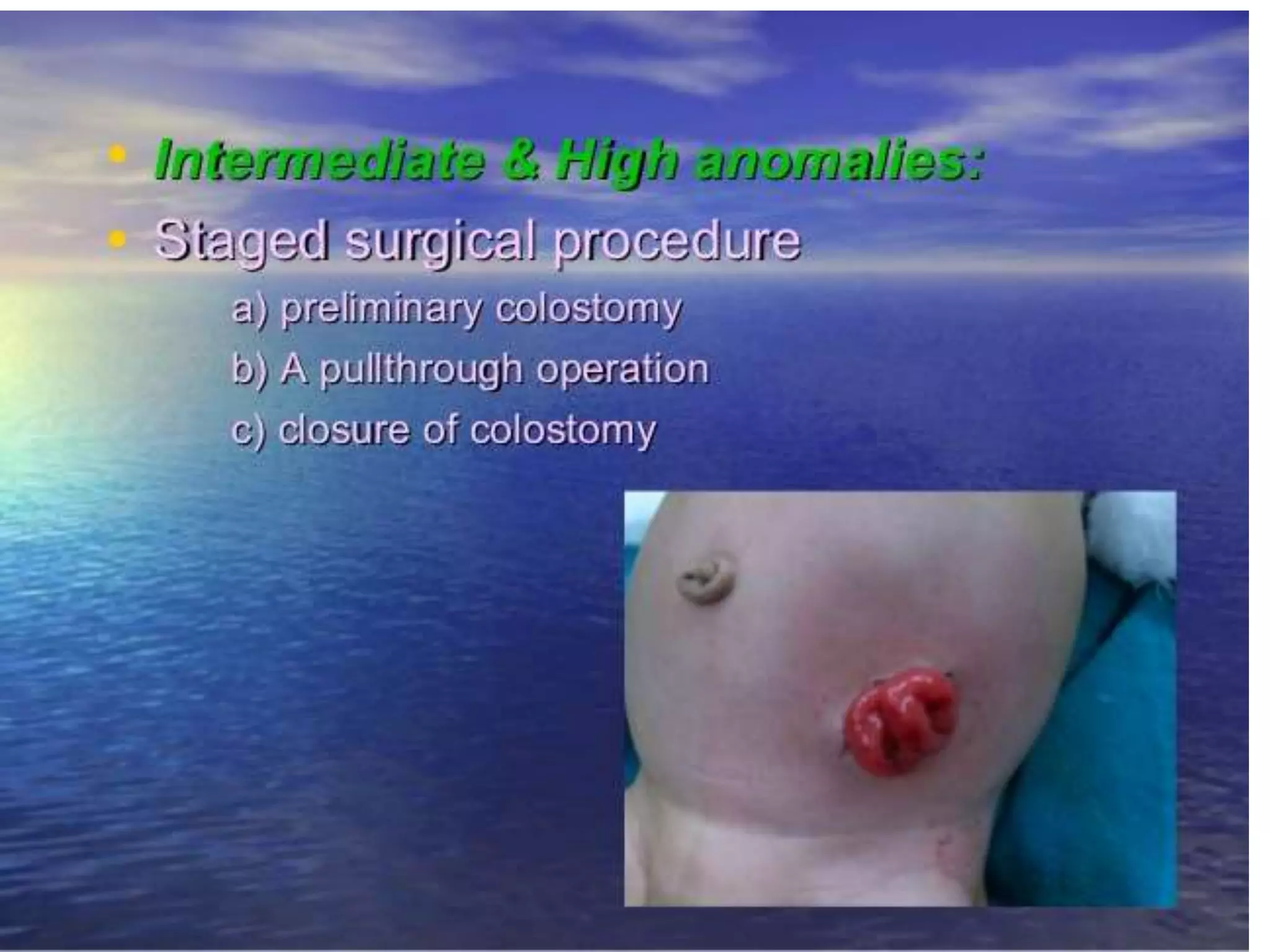 Anorectal malformation ppt 5 | PPT