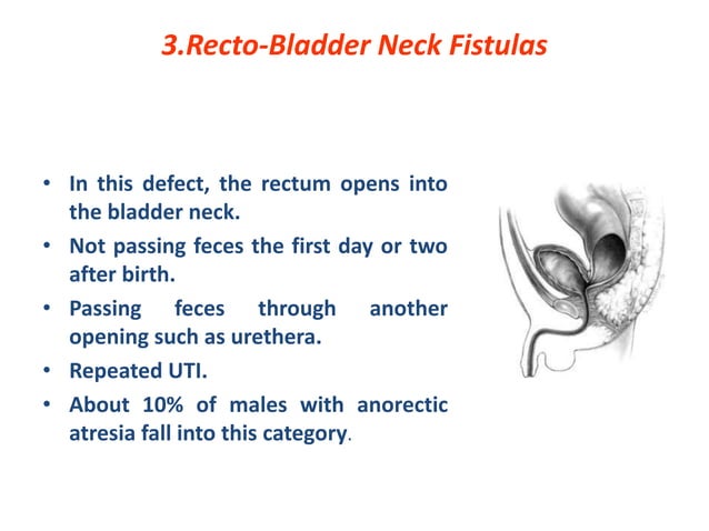 Anorectal malformation ppt 5 | PPT | Digestive Disorders | Diseases and ...