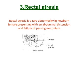Anorectal malformation ppt 5 | PPT