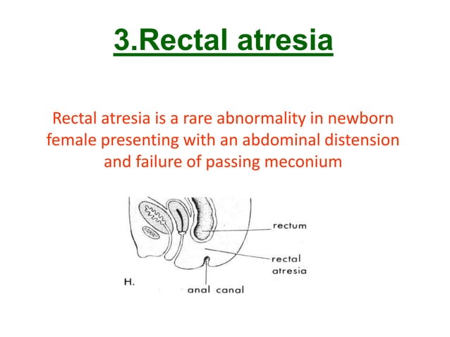 Anorectal malformation ppt 5 | PPT