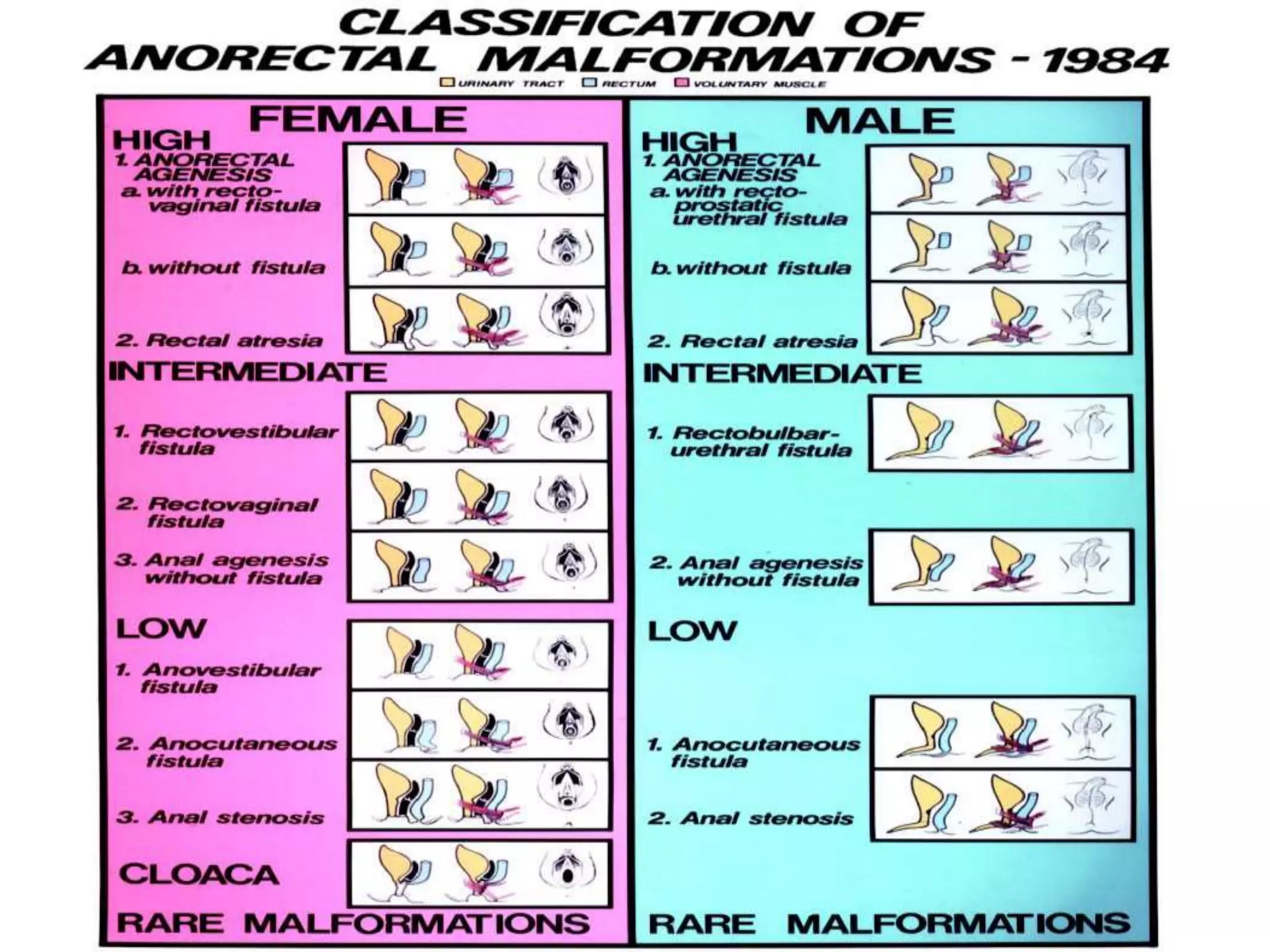 Anorectal malformations: embryology, classification, diagnosis and ...