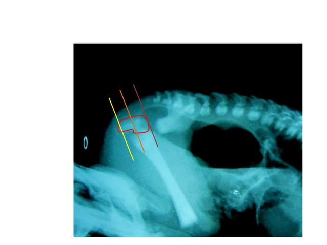 Anorectal malformations: embryology, classification, diagnosis and ...