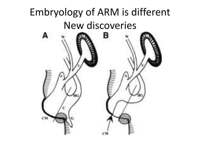 Anorectal malformations: embryology, classification, diagnosis and ...