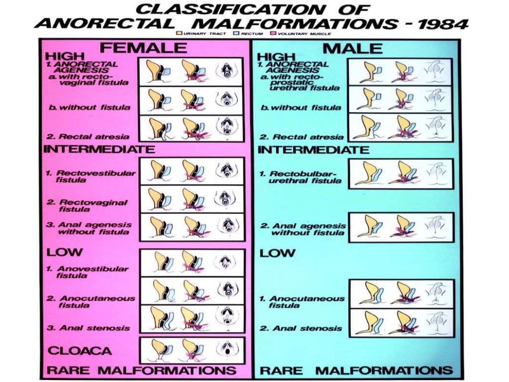 Anorectal malformations: embryology, classification, diagnosis and ea…