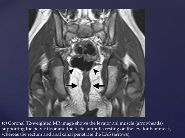 Anorectal malformations