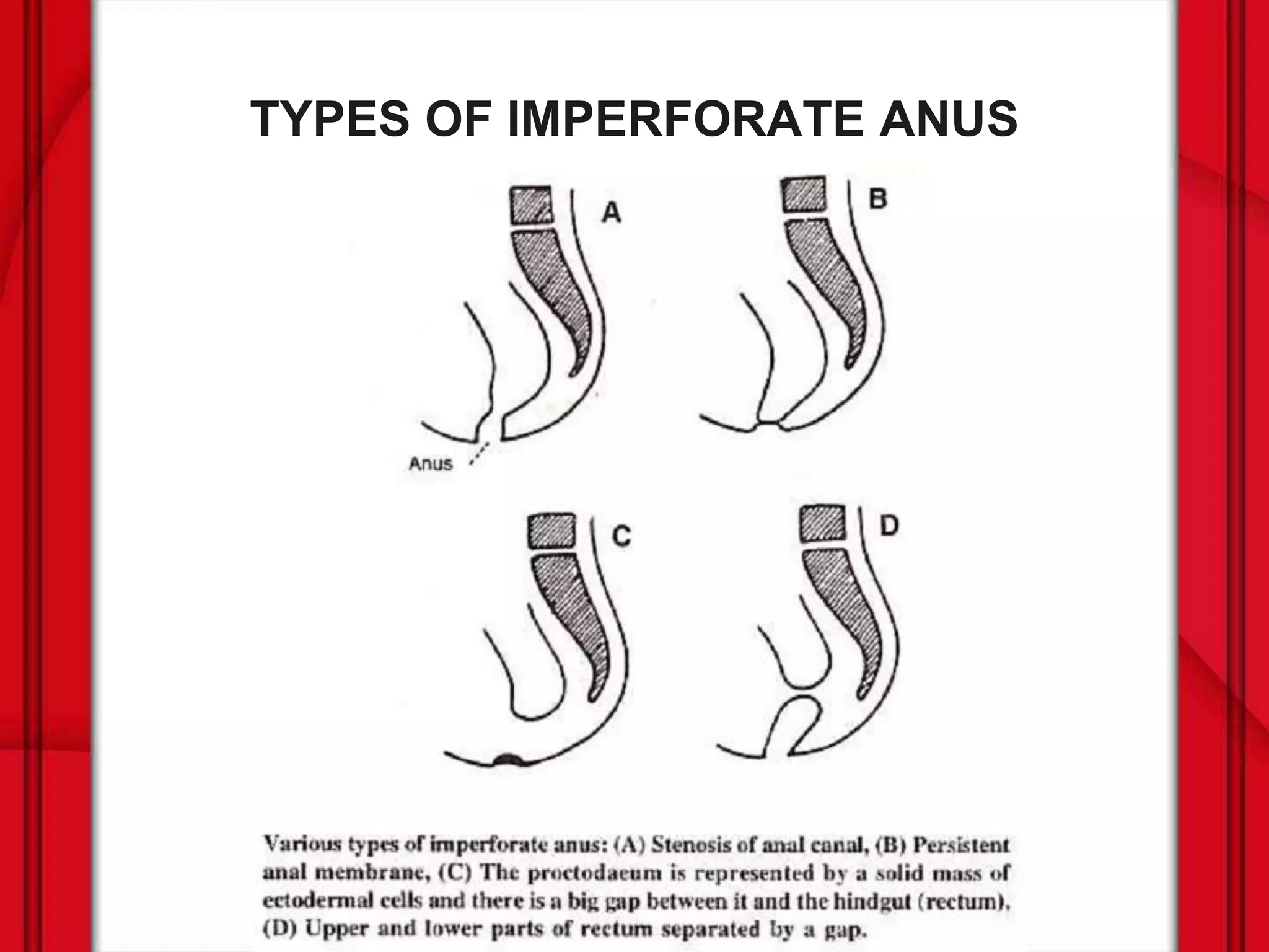 Anorectal malformations | PPTX