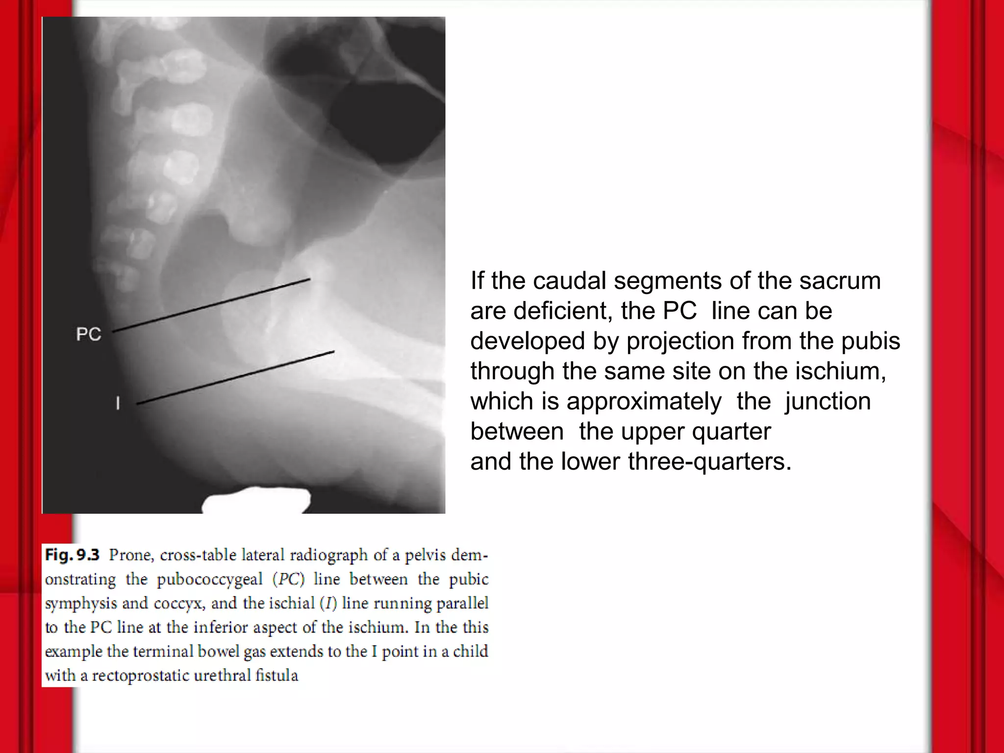 Anorectal malformations | PPTX