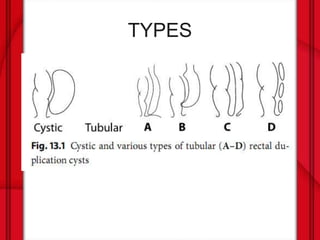 Anorectal malformations | PPTX