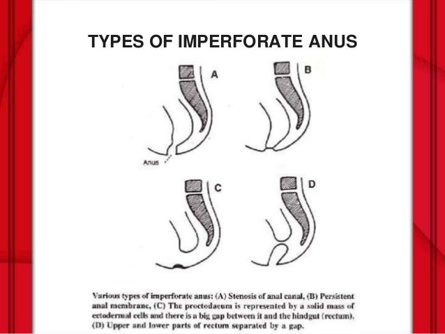 Anorectal malformations
