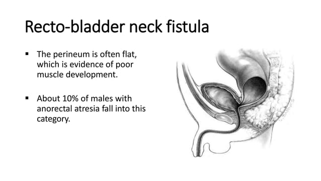 Anorectal malformations.pptx