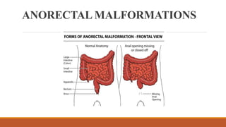 ANORECTAL MALFORMATIONS123456778900.pptx