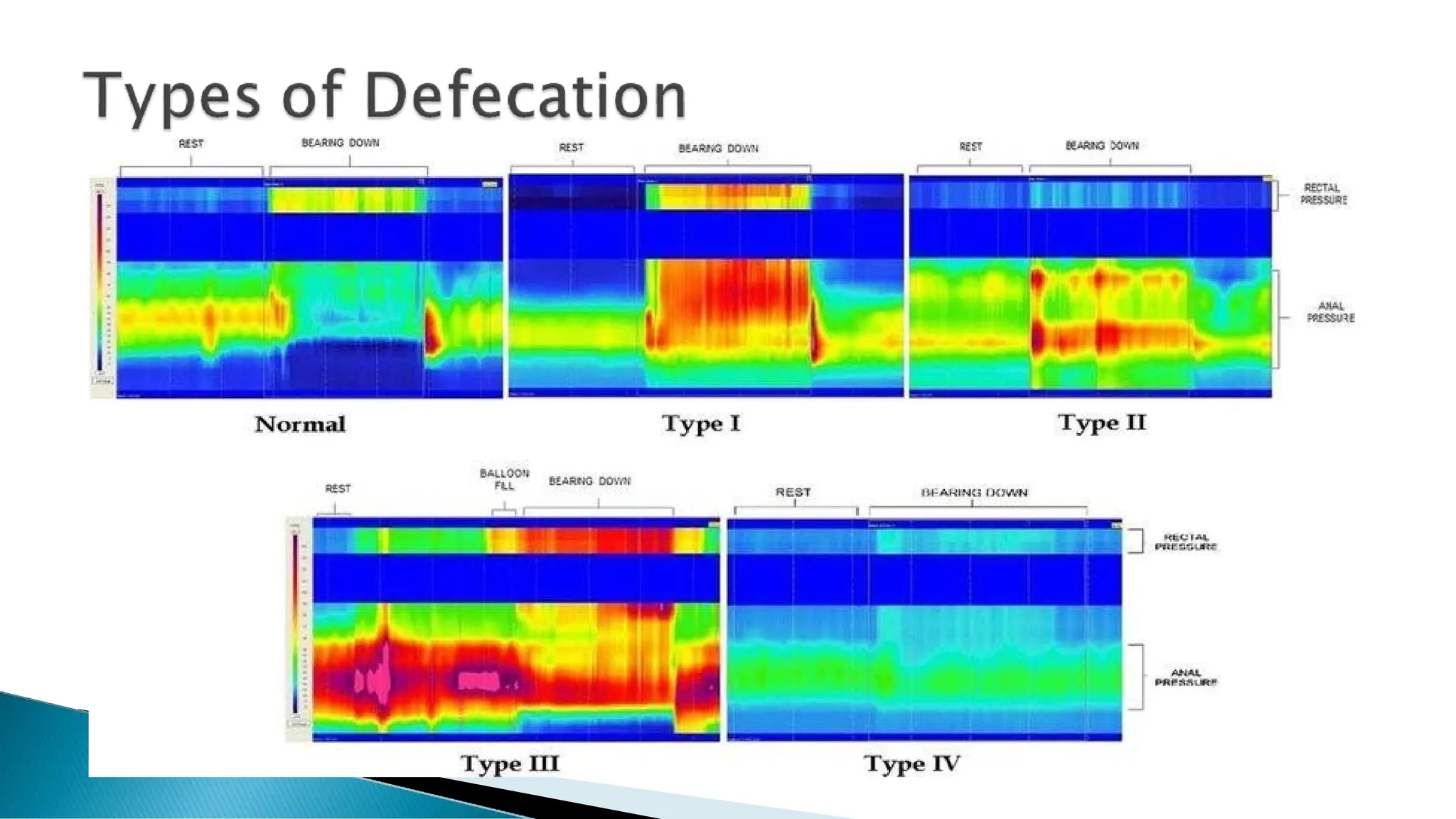 Anorectal Manometry detail presentation . | PPTX