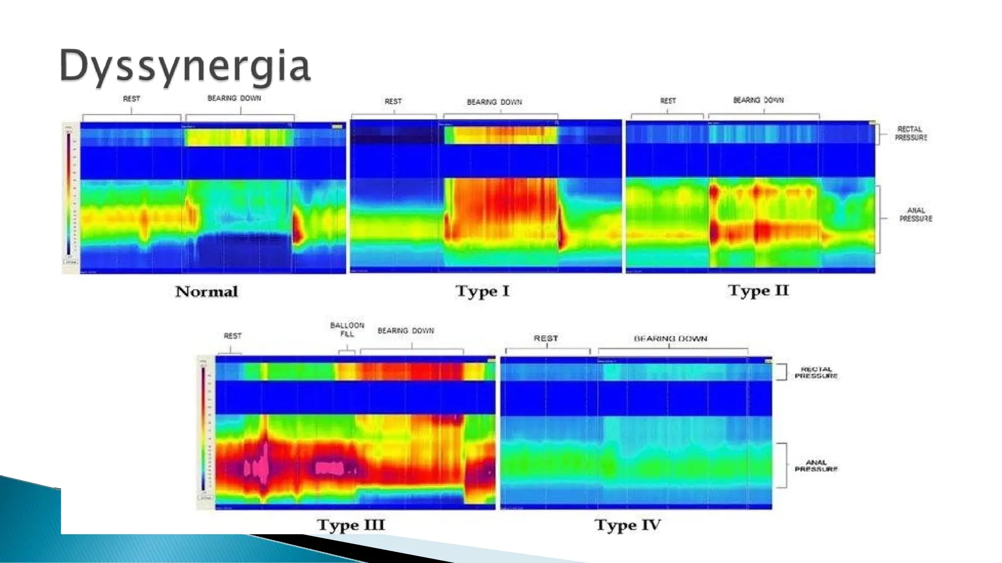 Anorectal Manometry detail presentation . | PPTX