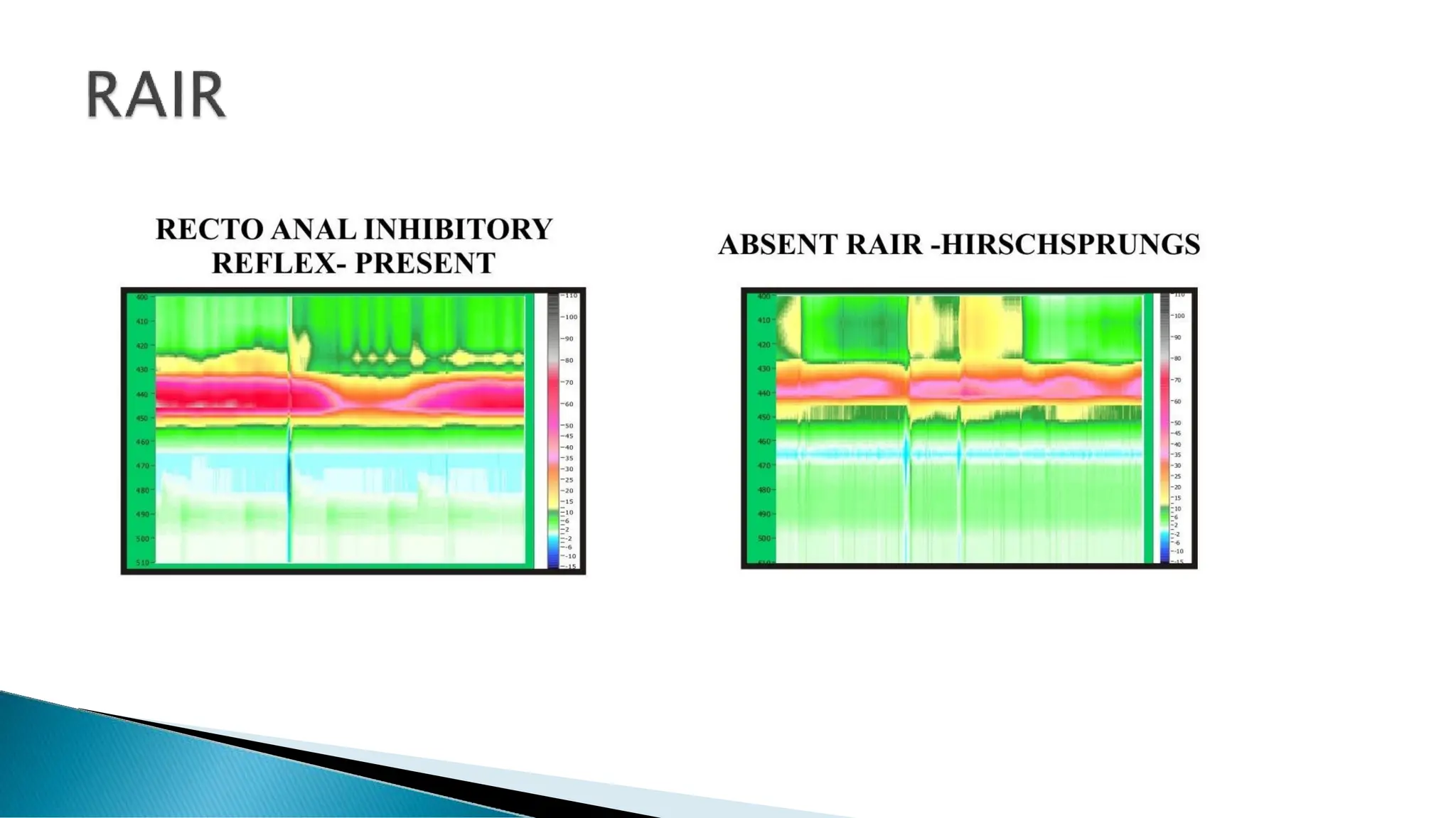 Anorectal Manometry detail presentation . | PPTX