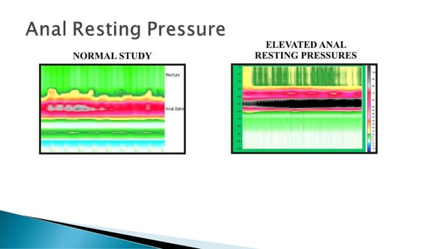Anorectal Manometry detail presentation . | PPTX