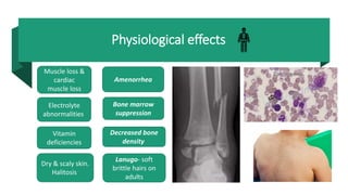 anorexia nervosa - shalu's .pptx