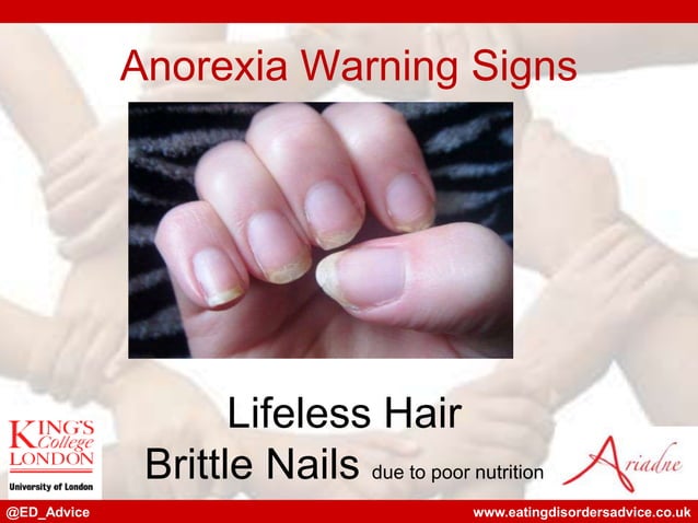 Anorexia warning signs | PPT