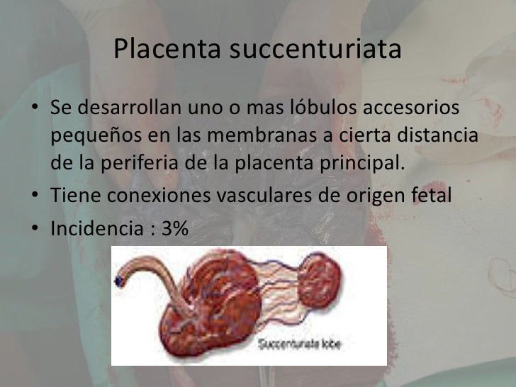 Placenta Succenturiata