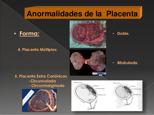 Placenta Circunmarginada Obstetrícia – Dr. Glaucius Nascimento