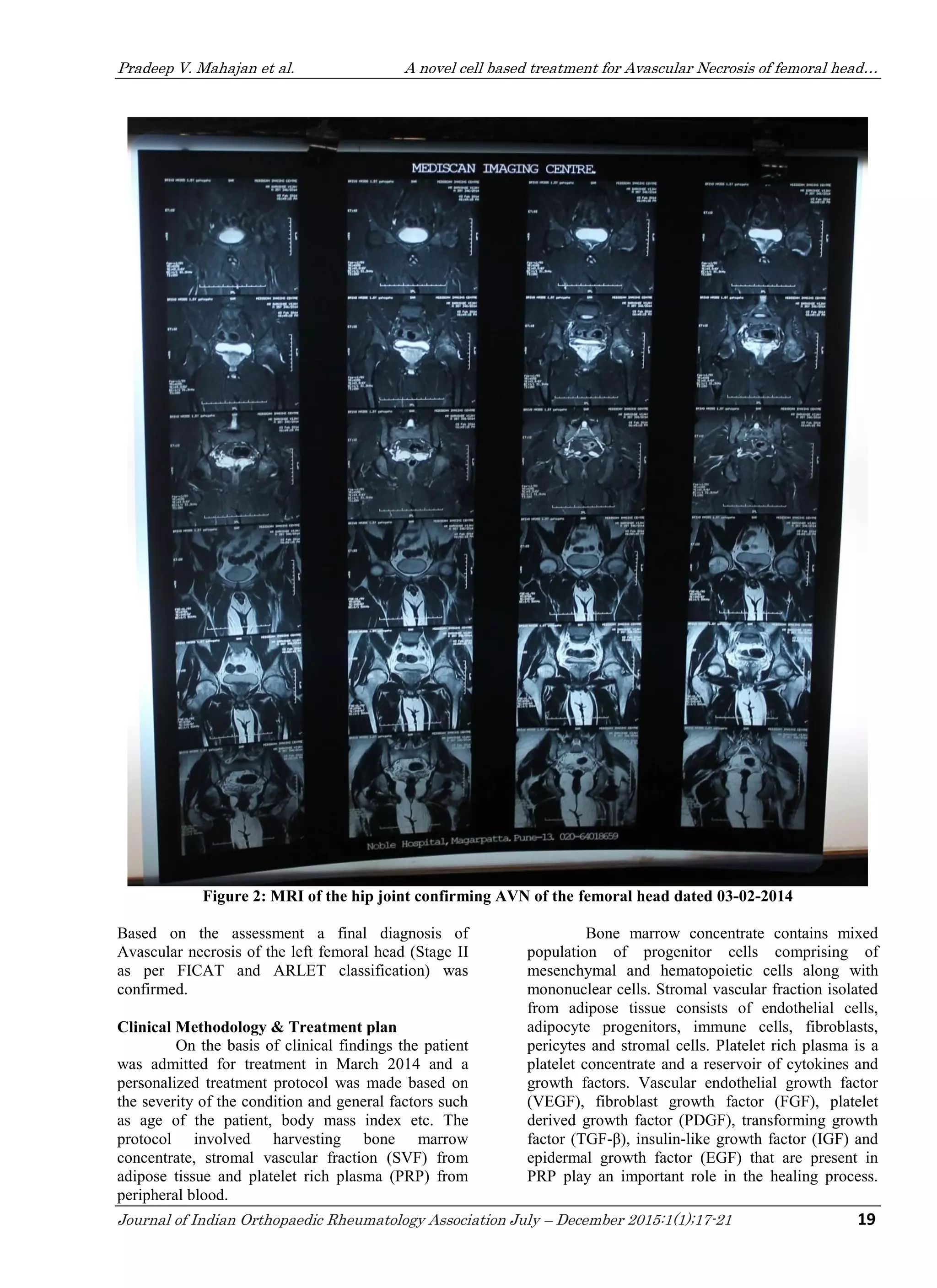 Stemcell Research Paper on avascular necrosis-AVN-by Dr.Pradeep Mahajan ...