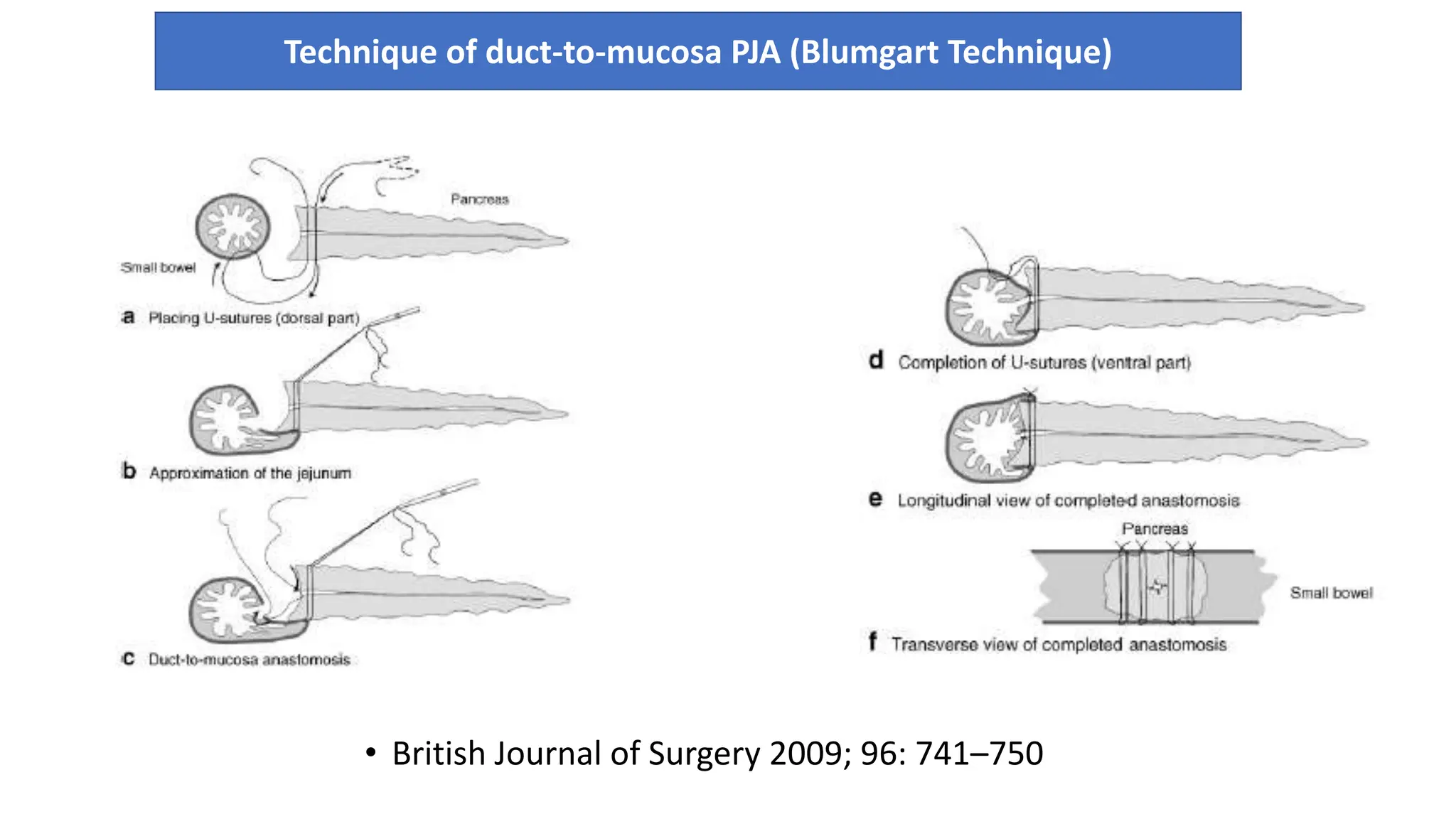 A novel technique of managing undilated small pancreatic duct.pptx