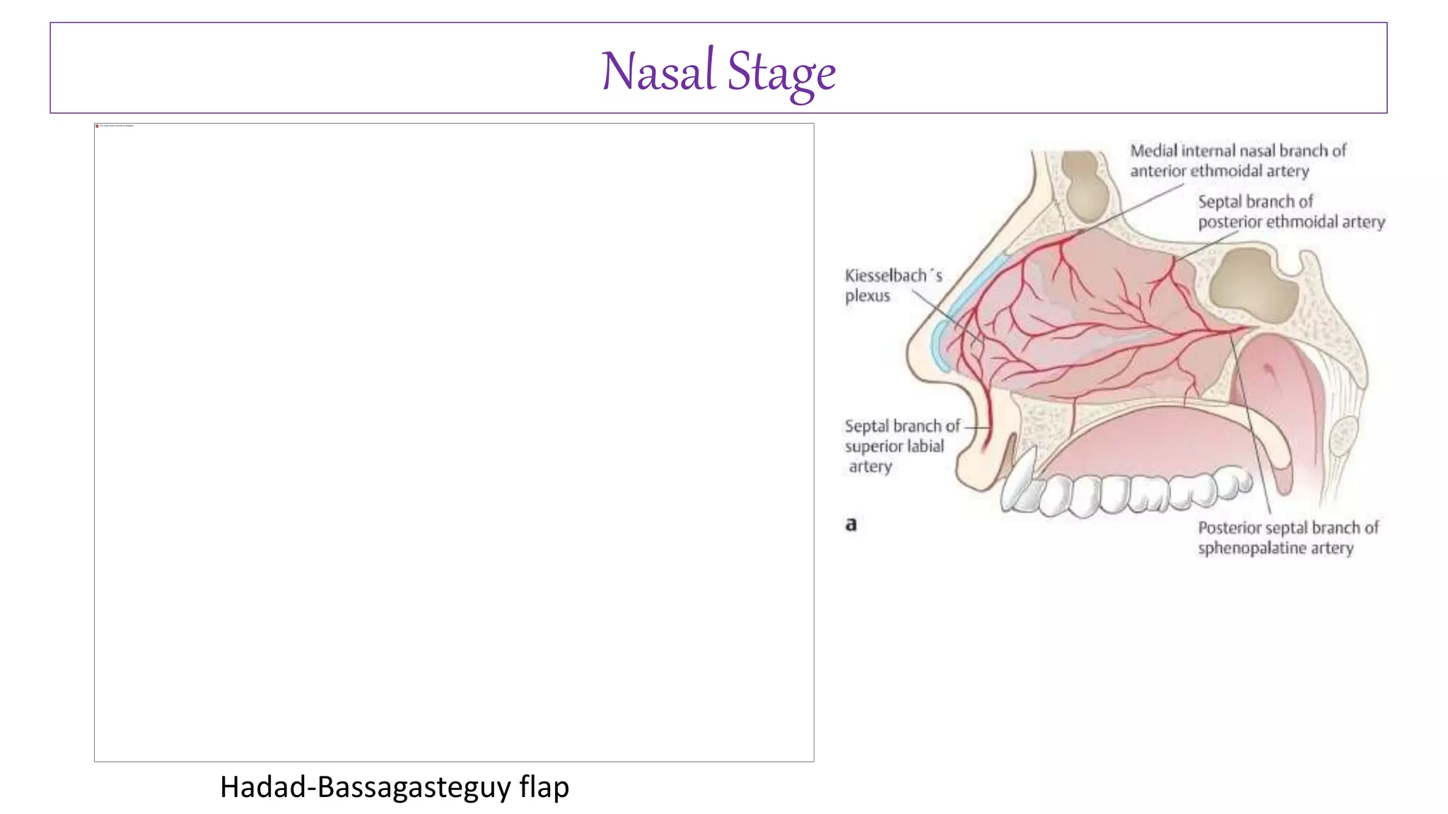 An Overview of Endoscopic endonasal Trans sphenoidal approach.pptx
