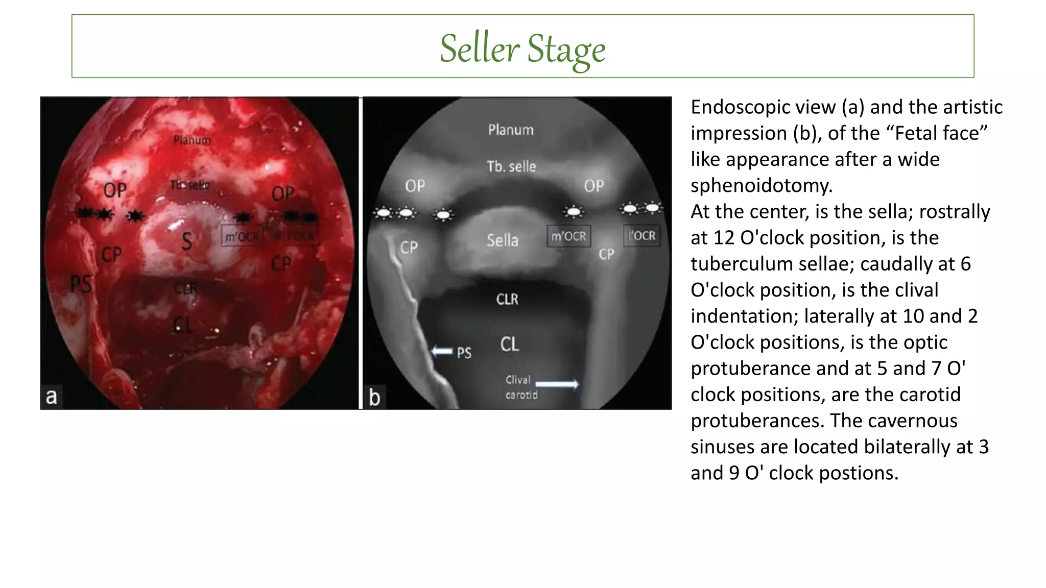 An Overview of Endoscopic endonasal Trans sphenoidal approach.pptx