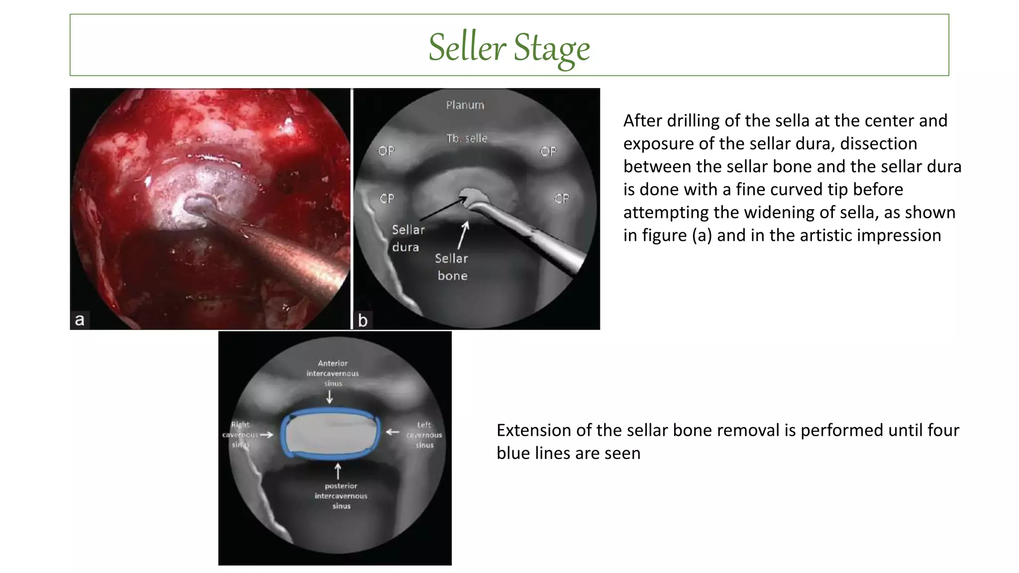 An Overview Of Endoscopic Endonasal Trans Sphenoidal Approach Pptx