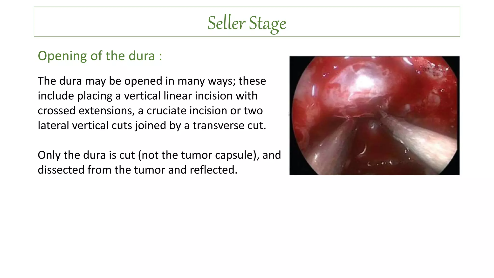 An Overview of Endoscopic endonasal Trans sphenoidal approach.pptx