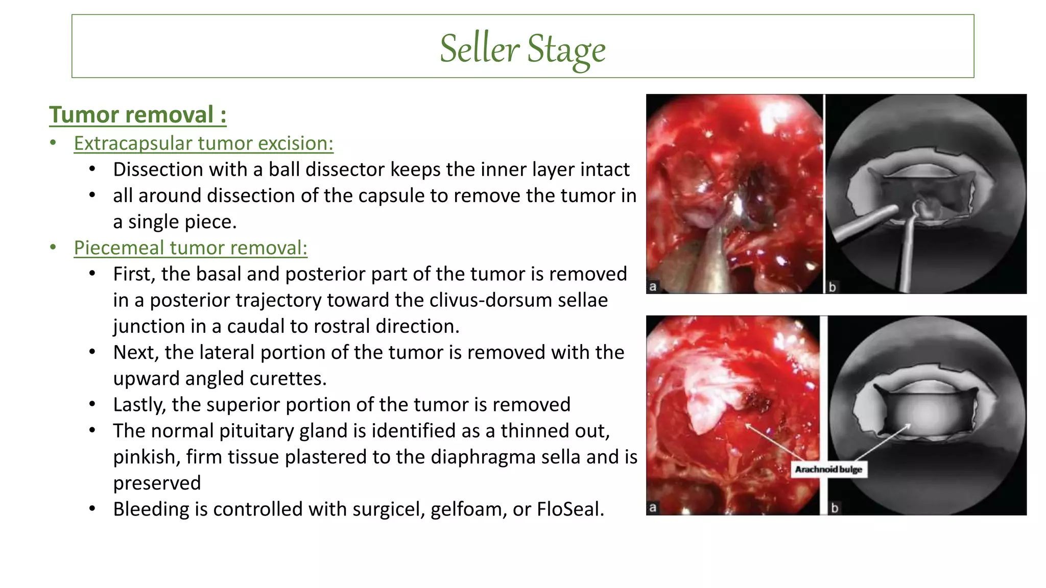 An Overview of Endoscopic endonasal Trans sphenoidal approach.pptx