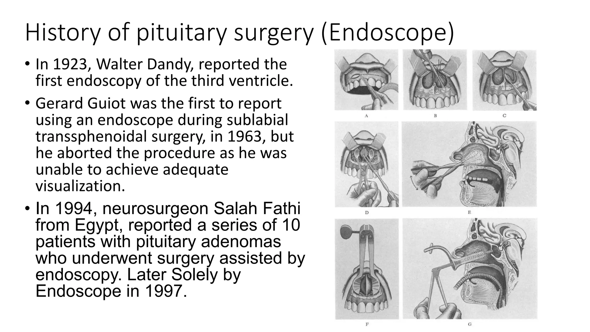 An Overview of Endoscopic endonasal Trans sphenoidal approach.pptx