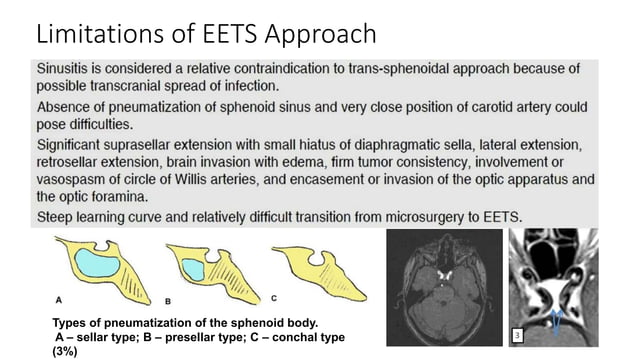An Overview of Endoscopic endonasal Trans sphenoidal approach.pptx