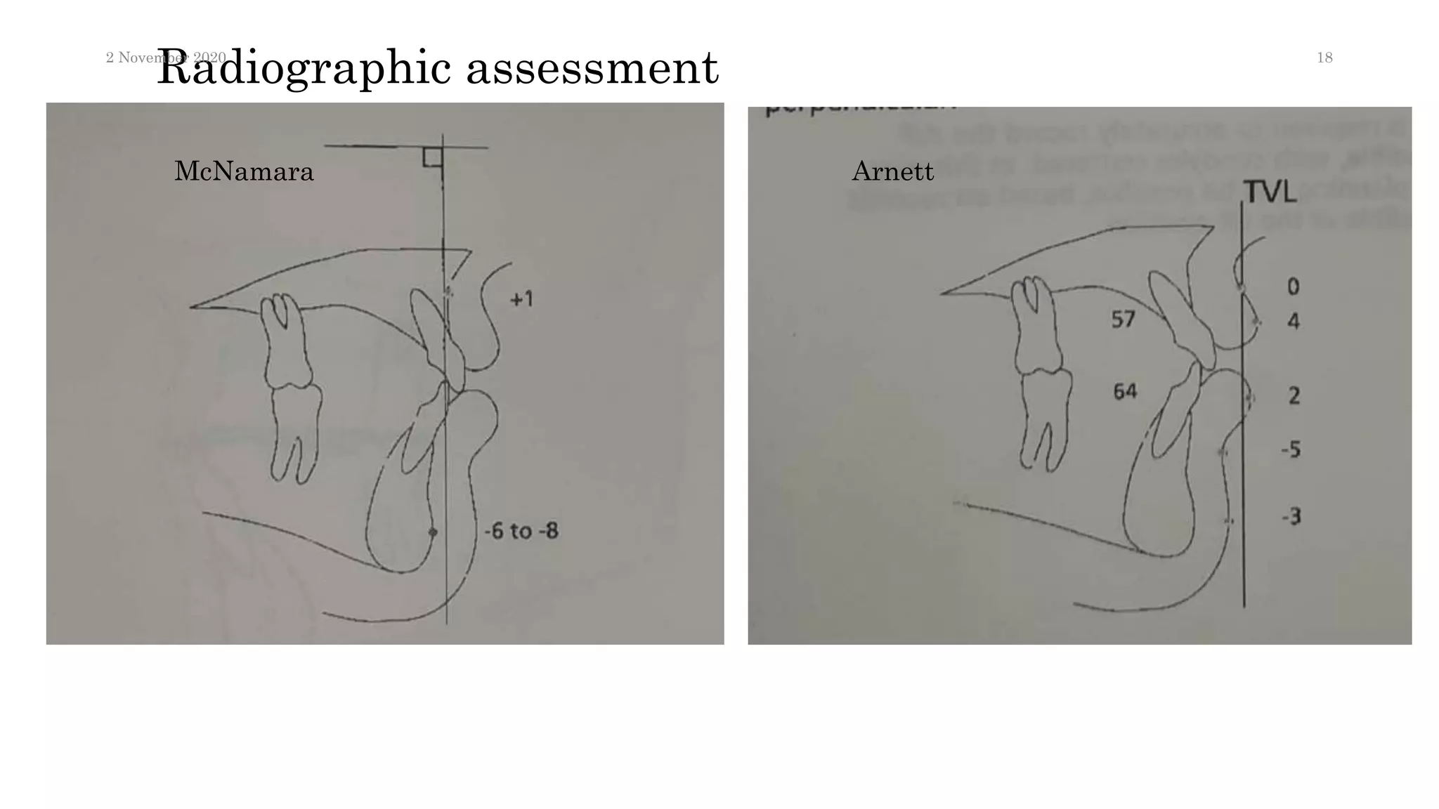 An overview of class III treatment in fixed Orthodontics by MBT system | PPTX