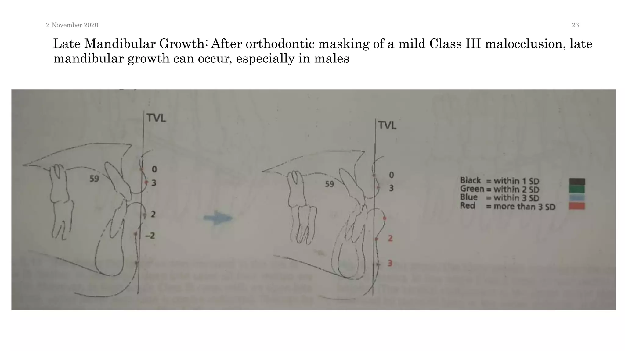 An overview of class III treatment in fixed Orthodontics by MBT system ...