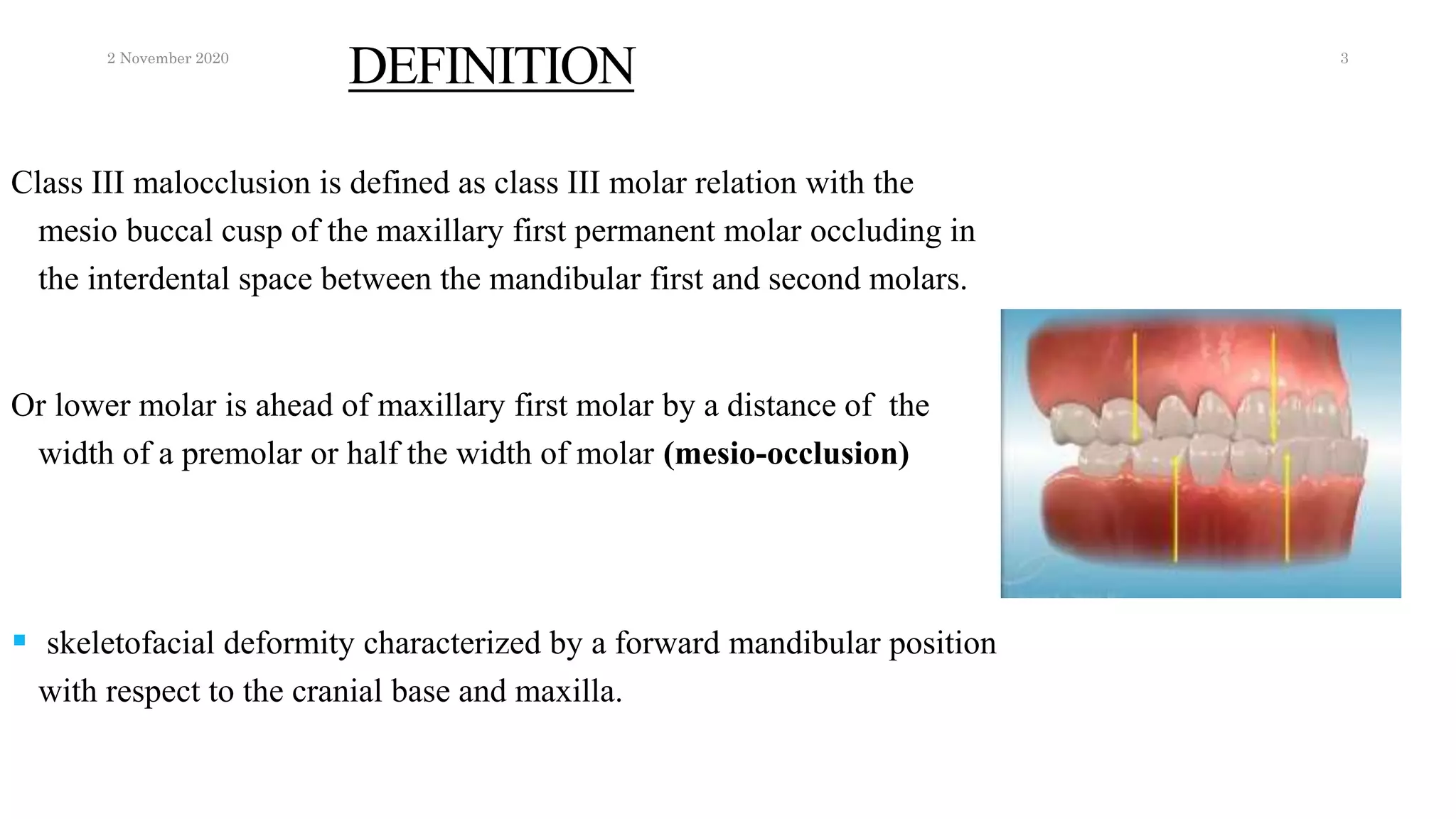 An overview of class III treatment in fixed Orthodontics by MBT system | PPTX