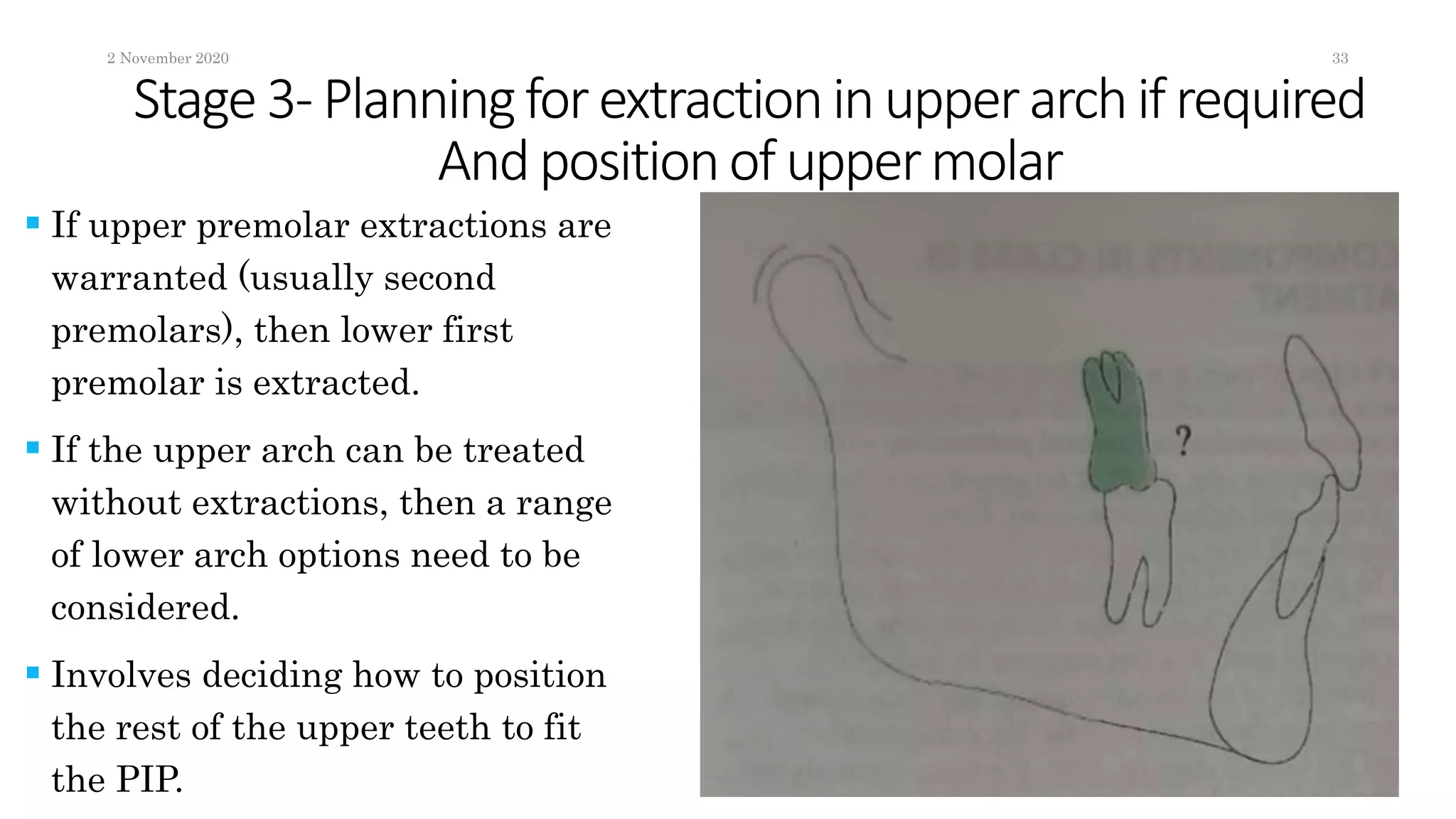 An overview of class III treatment in fixed Orthodontics by MBT system | PPTX