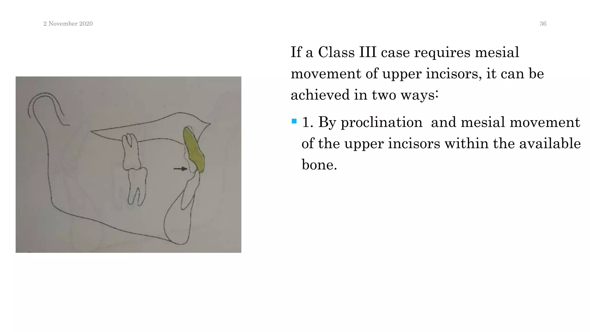 An overview of class III treatment in fixed Orthodontics by MBT system ...