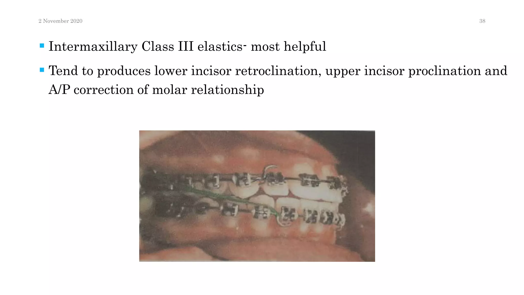 An overview of class III treatment in fixed Orthodontics by MBT system | PPTX