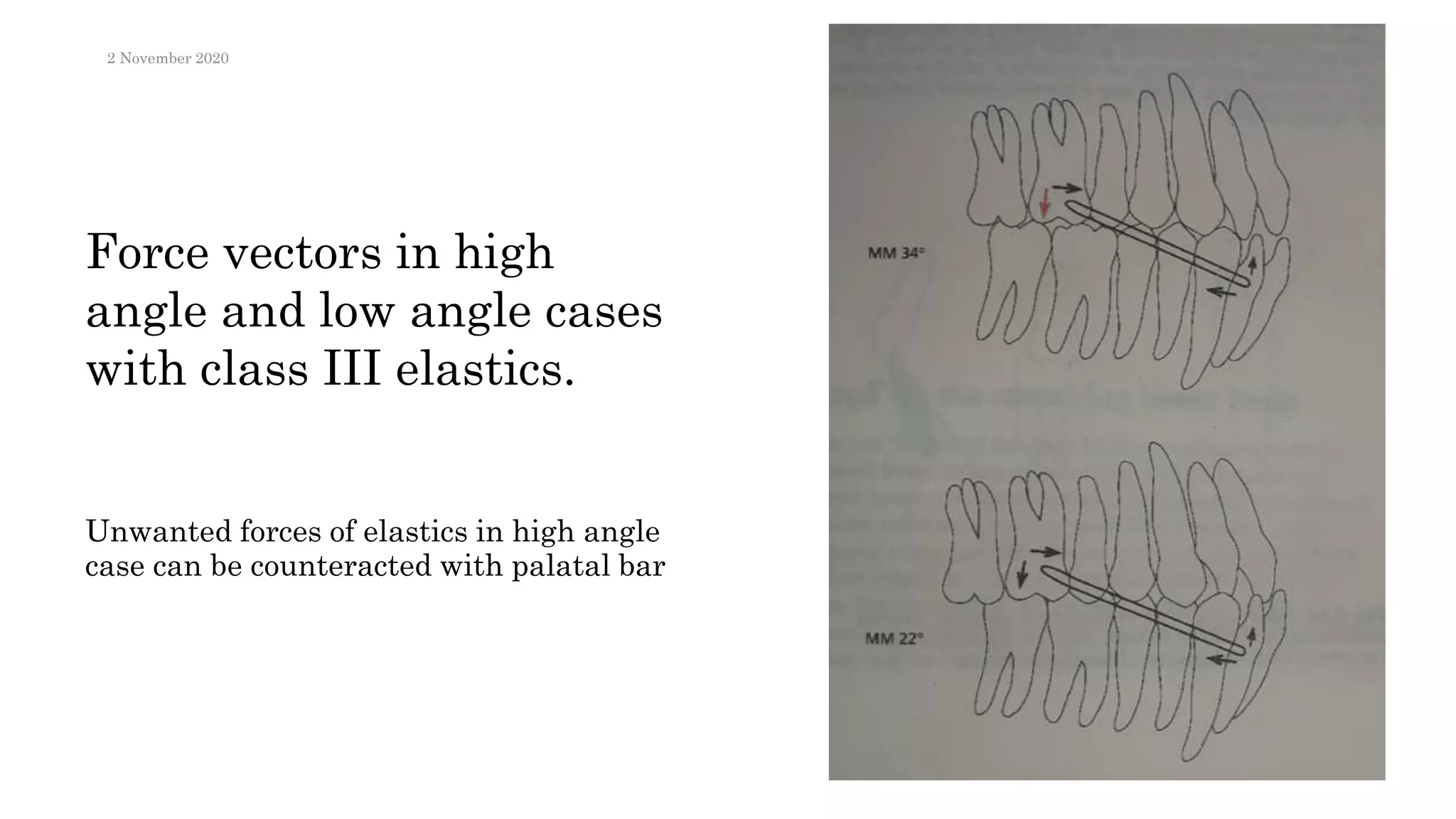 An overview of class III treatment in fixed Orthodontics by MBT system ...