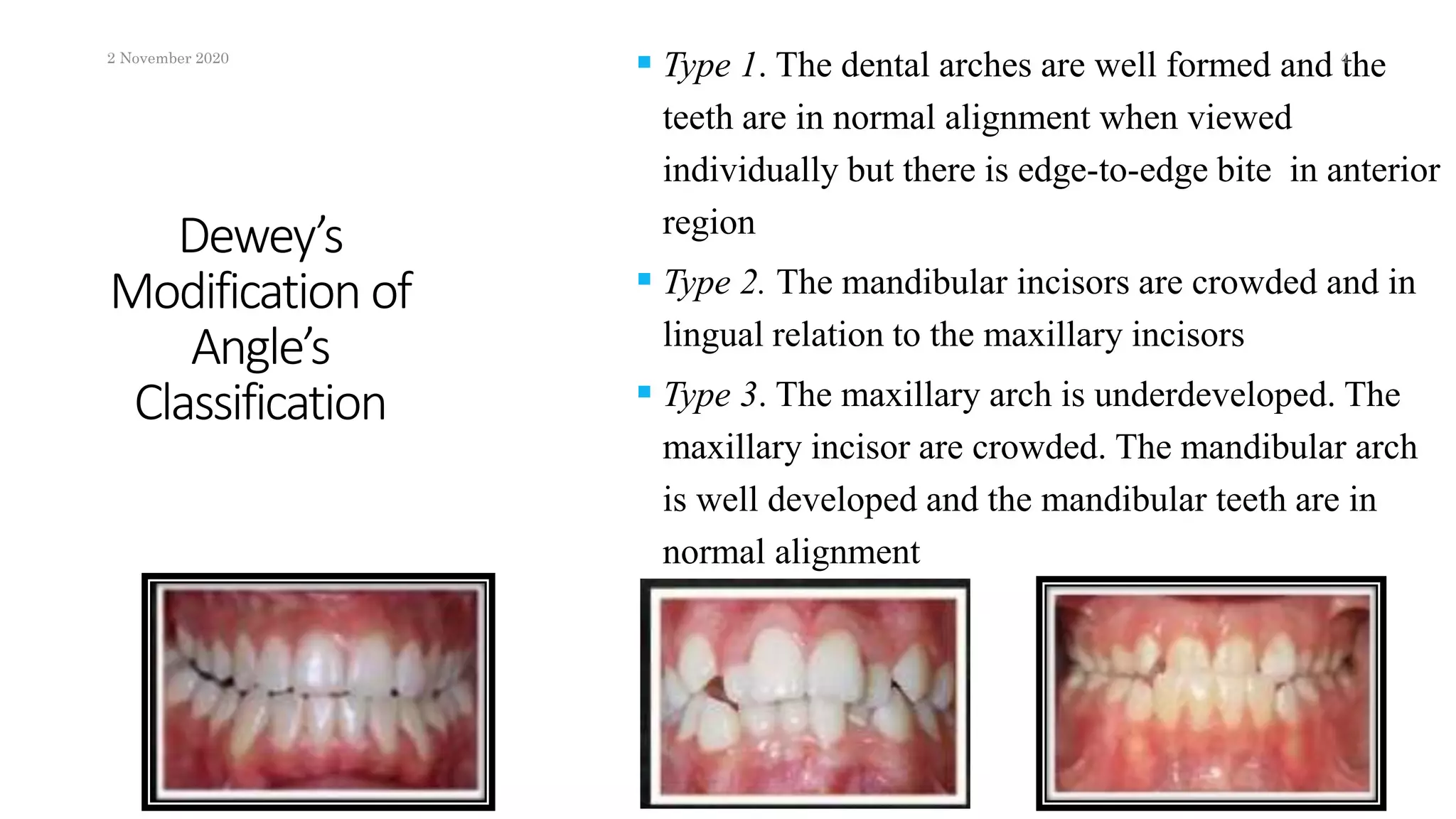 An overview of class III treatment in fixed Orthodontics by MBT system ...