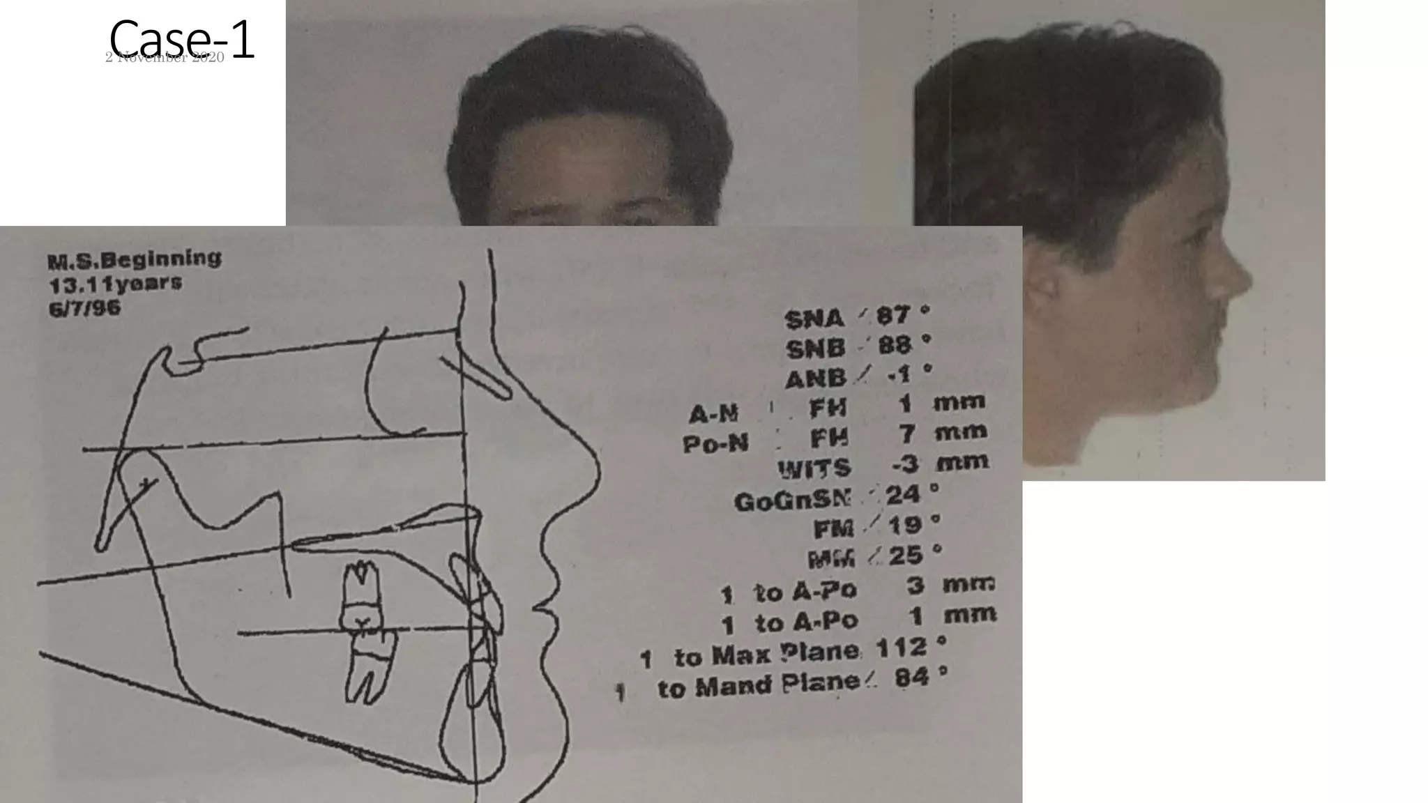 An overview of class III treatment in fixed Orthodontics by MBT system ...